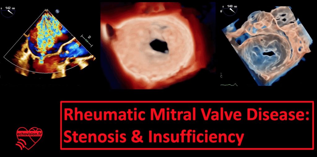 rheumatic mitral valve disease Acep // american college of emergency ... rheumatic mitral valve disease Acep // american college of emergency ...