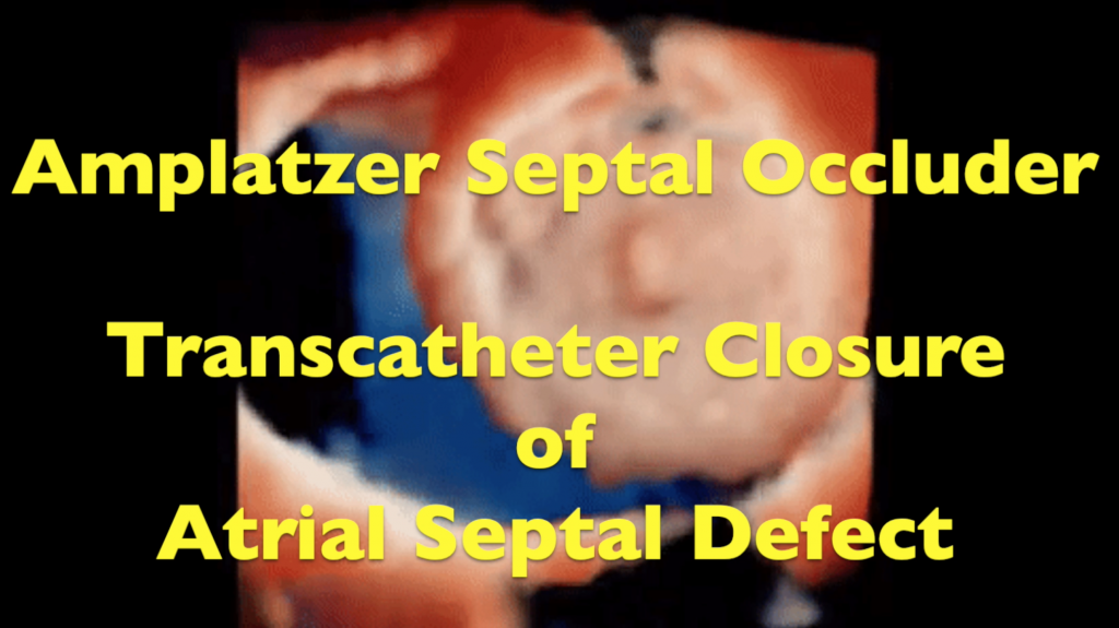 Amplatzer Atrial Septal Occluder: Transcathter Closure Of A large ...